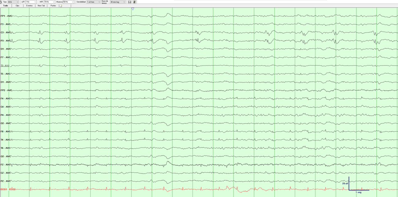 Patrones EEG | Seepnet