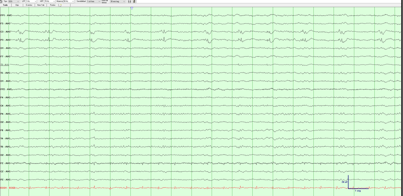 Patrones EEG | Seepnet