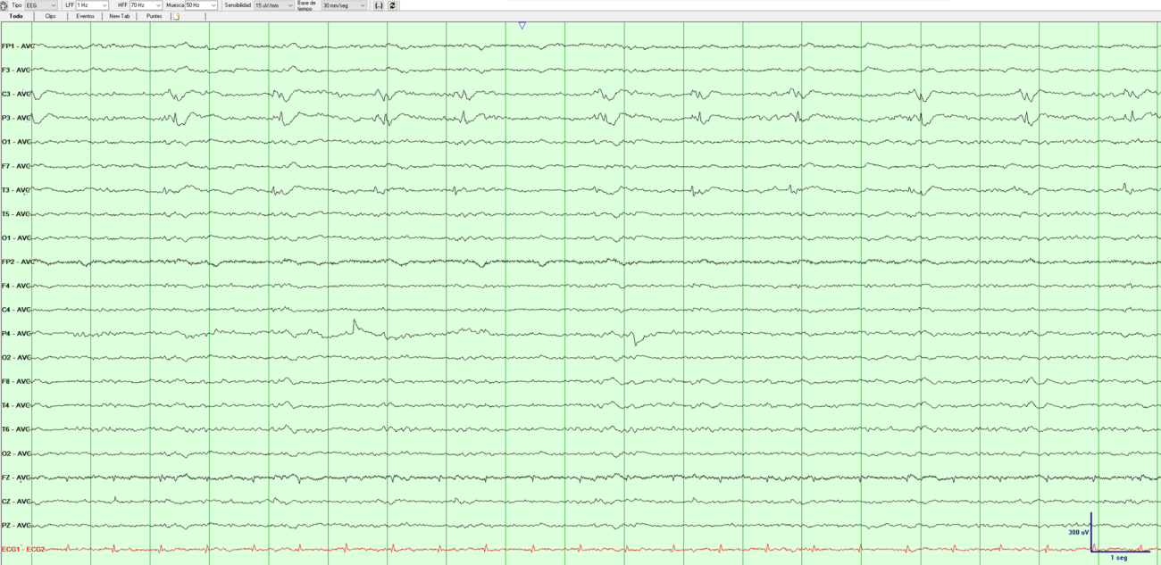 Patrones EEG | Seepnet