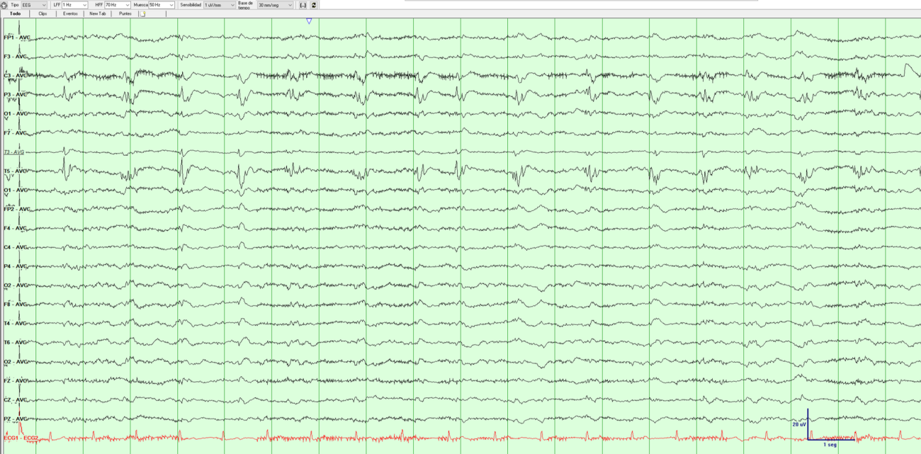 Patrones EEG | Seepnet