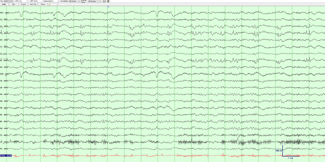 Patrones EEG | Seepnet
