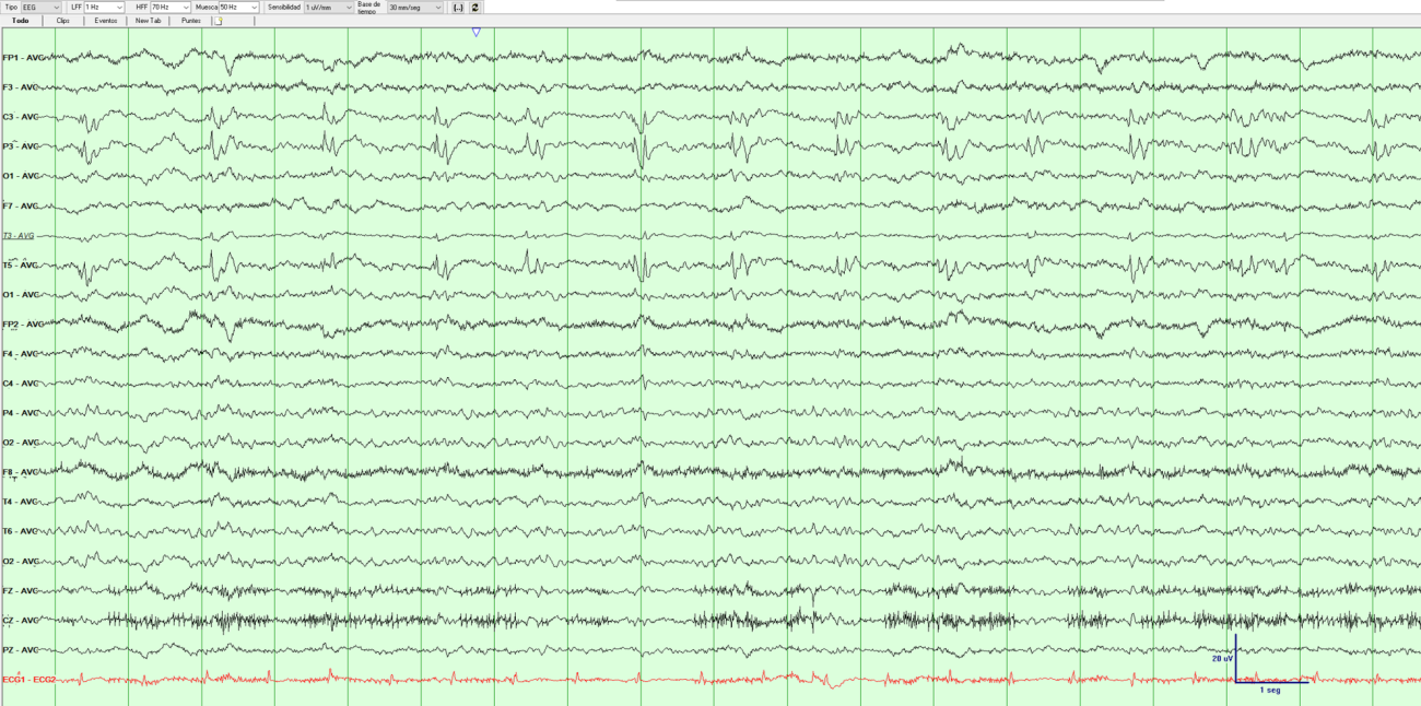 Patrones EEG | Seepnet