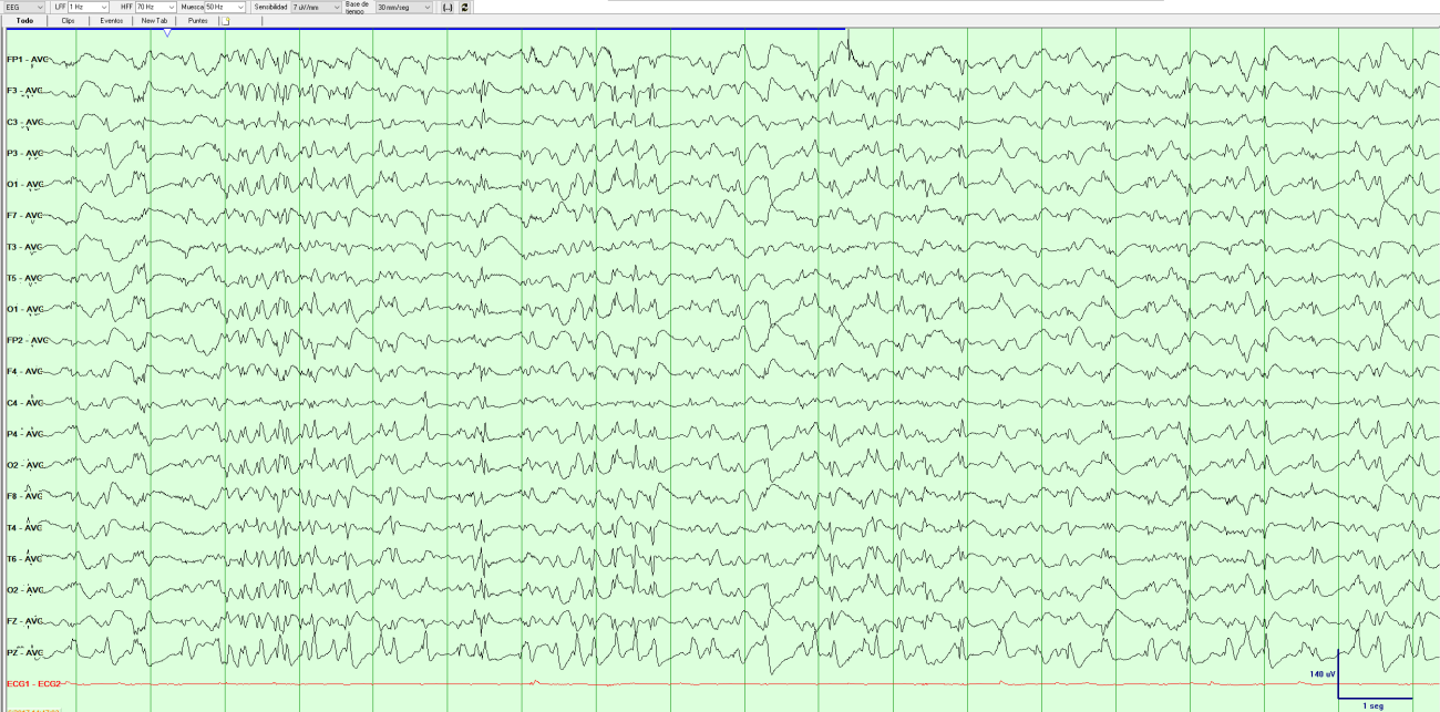 Patrones EEG | Seepnet