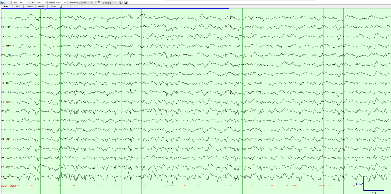 Patrones EEG | Seepnet