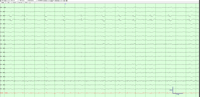 Patrones EEG | Seepnet