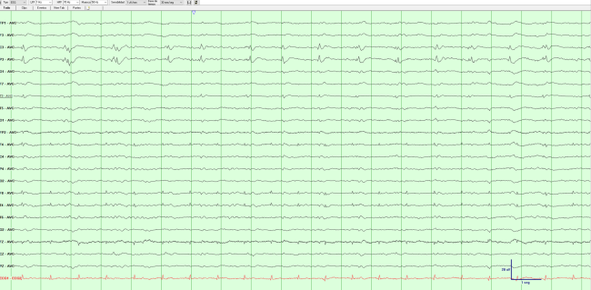 Patrones EEG | Seepnet
