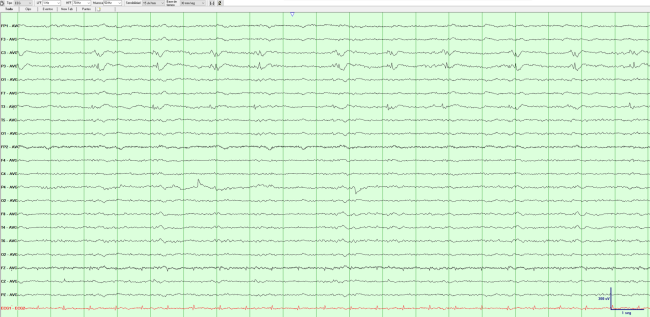 Patrones EEG | Seepnet