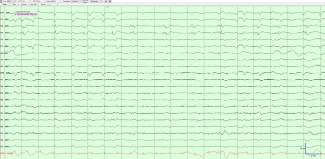 Patrones EEG | Seepnet