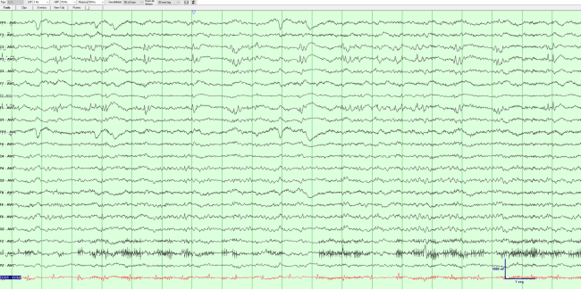 Patrones EEG | Seepnet