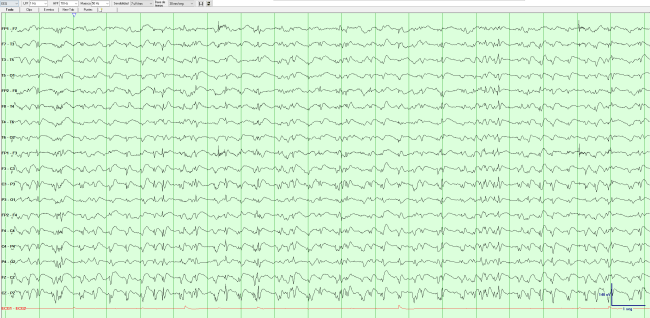 Patrones EEG | Seepnet