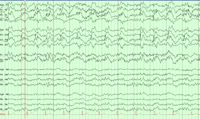 Patrones EEG | Seepnet
